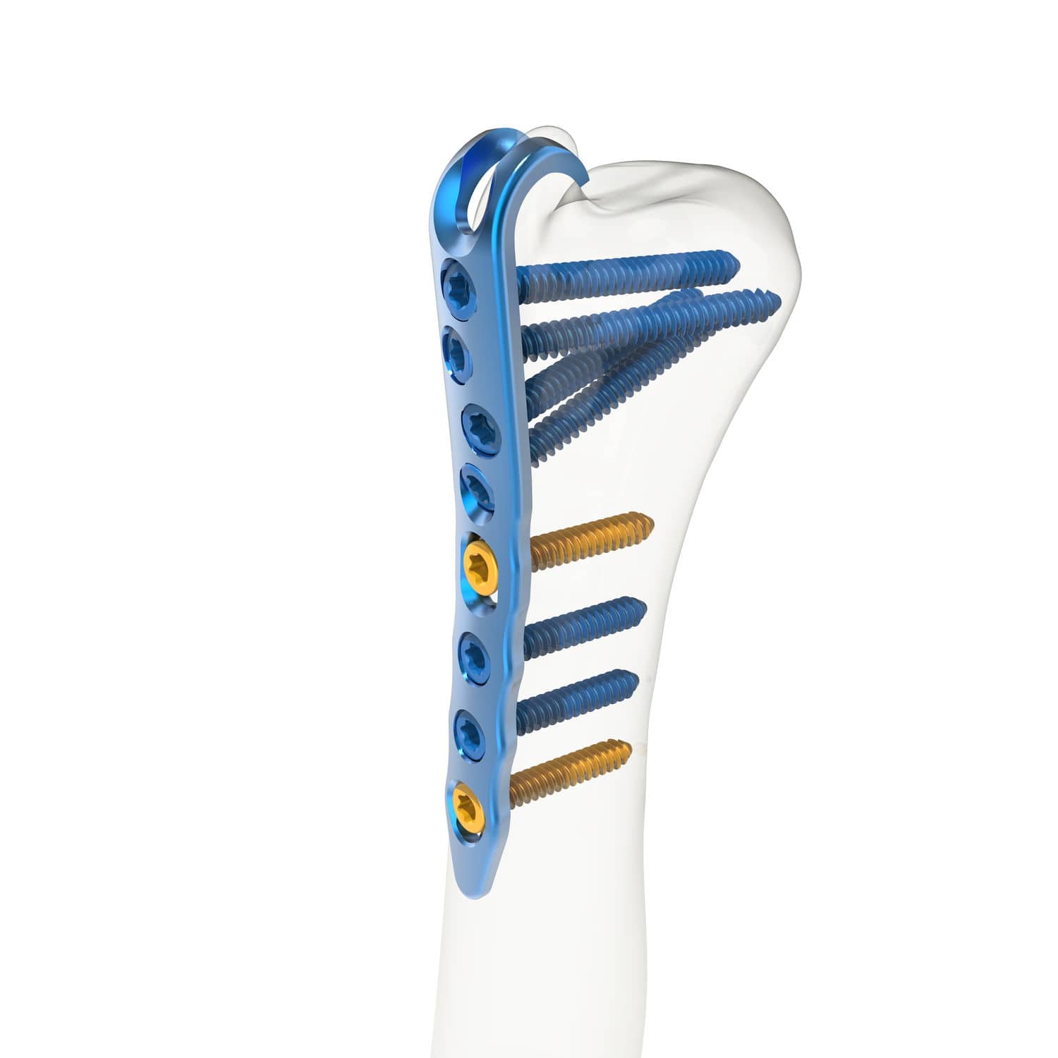 Plaque de compression ulna - ARIX - Jeil Medical Corporation - distale