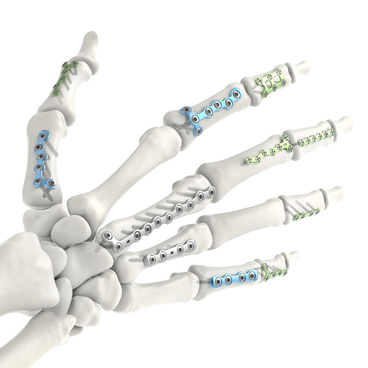 Plaque de compression de phalange de la main - Jeil Medical Corporation ...