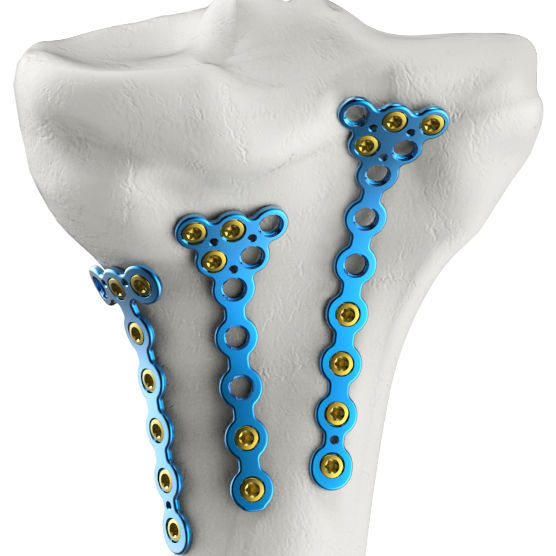 Plaque de compression de petit fragment osseux - Jeil Medical ...