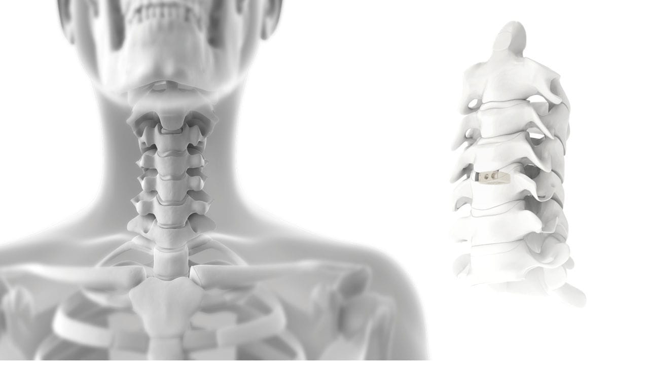 Cage intersomatique cervicale - FIX-C - Jeil Medical Corporation - voie ...