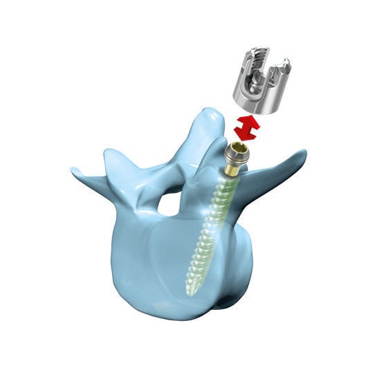 Vis pédiculaire lombaire - “mediRod®”-Tri - Medicon eG - polyaxiale ...