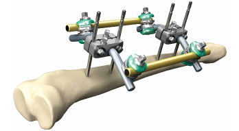 Fixateur externe modulaire / tubulaire - Hoffmann 3 - Stryker