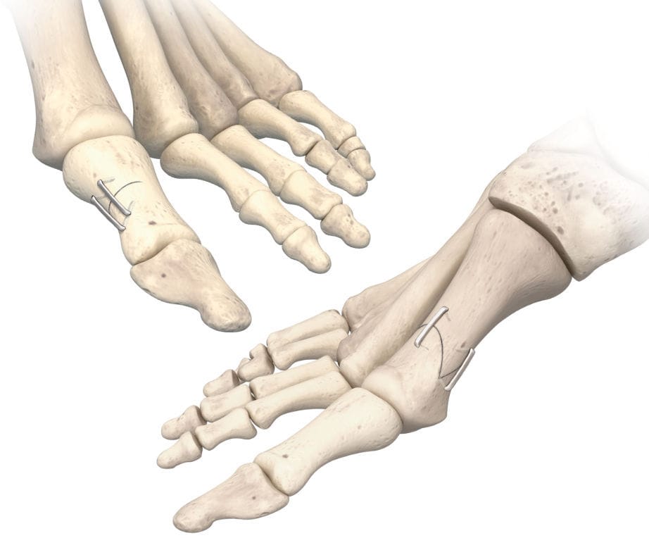 Agrafe orthopédique tarse - EasyClip - Stryker - phalange du pied ...