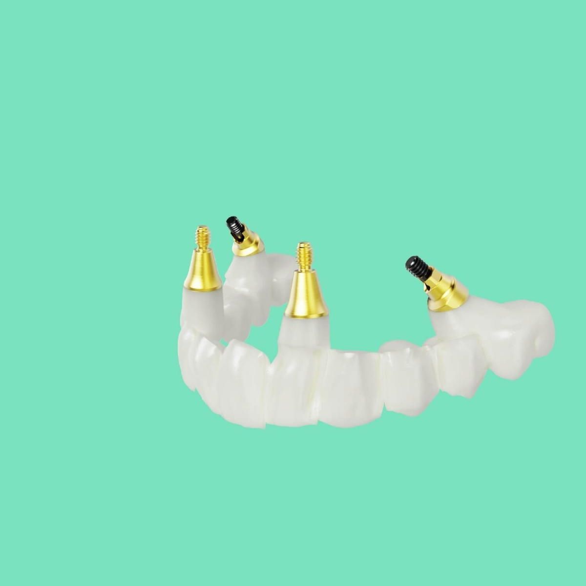 Bridge dentaire en zircone - NobelProcera® - Nobel Biocare Services AG ...