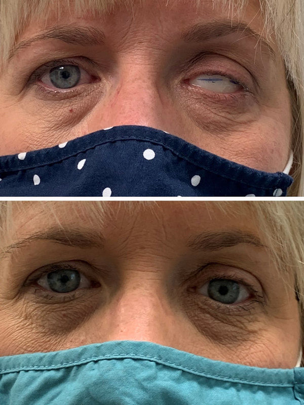 Épithèse oculaire - The Anaplastology Clinic - adulte