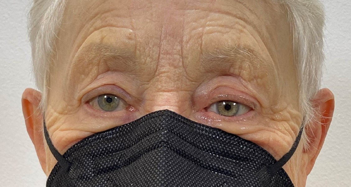 Épithèse oculaire - Scleral Shells - The Anaplastology Clinic - adulte