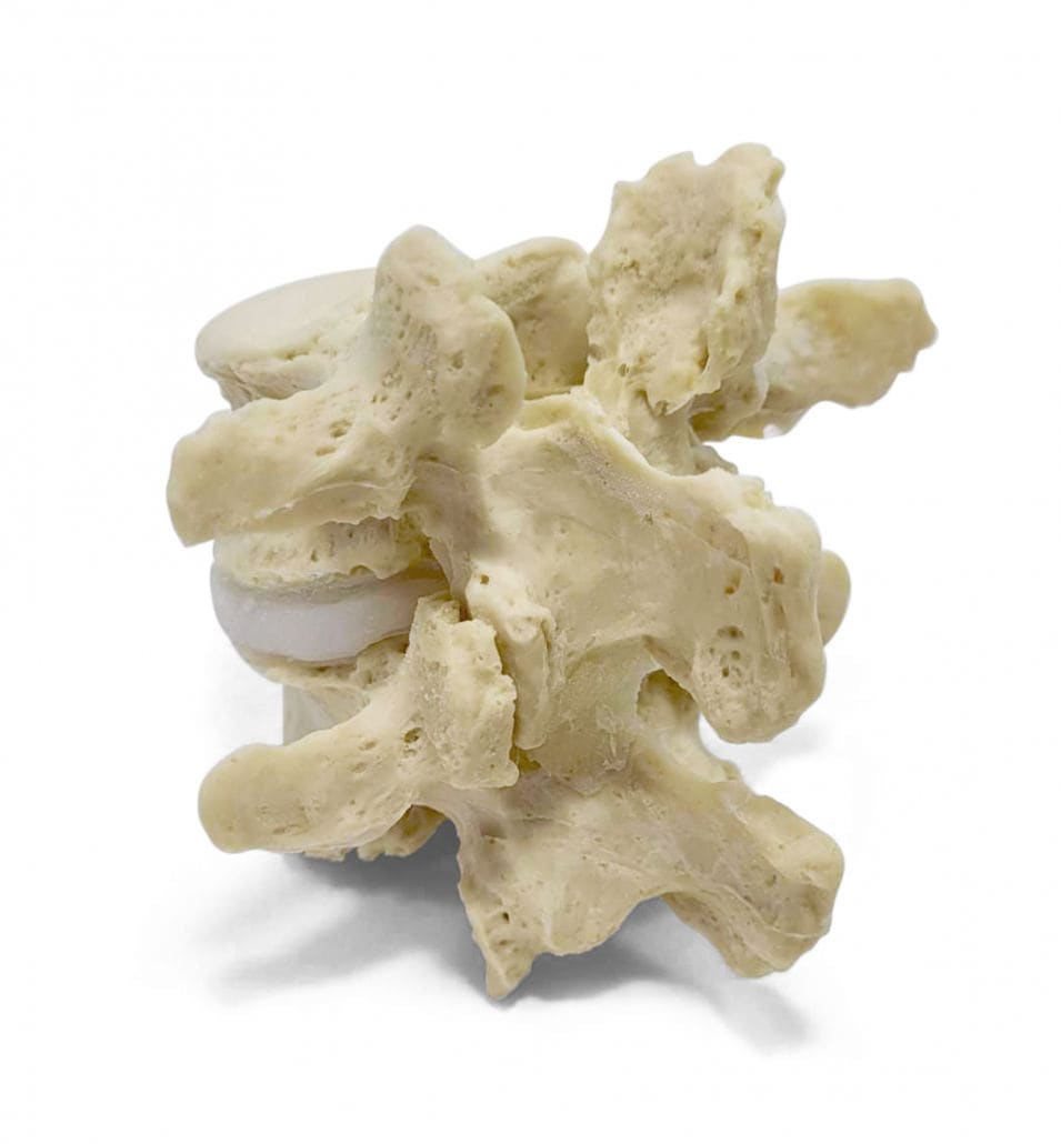 Modèle anatomique de vertèbres lombaires - Dynamic Disc Designs Corp ...