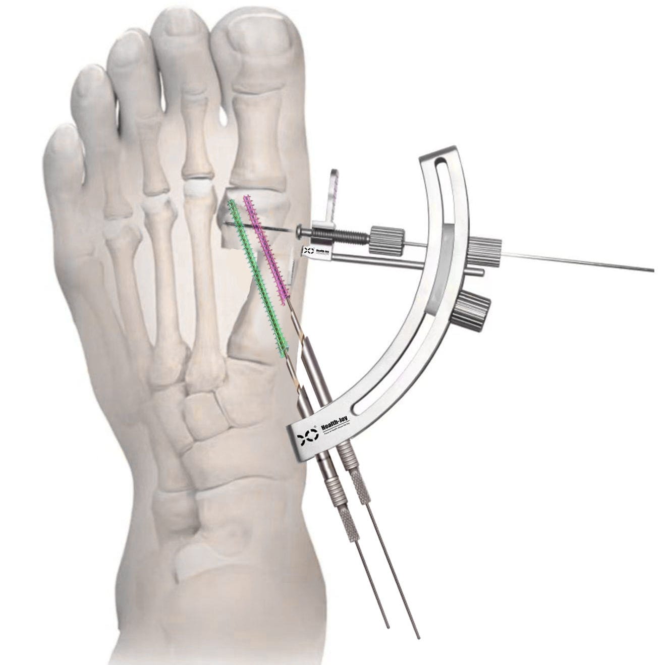 Kit d'instruments pour chirurgie mini-invasive de l'avant-pied - HJ ...