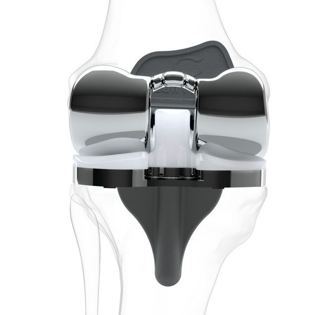 Prothèse de genou tricompartimentale - iTotal PS - ConforMIS - à ...