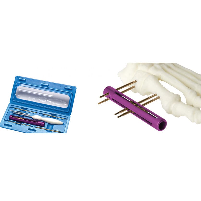 Fixateur externe de tarse - SIDEKICK™ - Wright Medical Technology ...