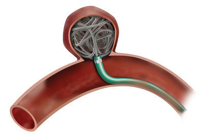 Spirale d'embolisation - HyperSoft® 3D - MicroVention