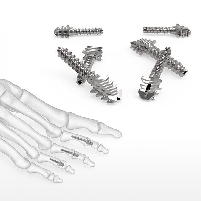 Vis de compression à os d'articulation métatarso-phalangienne ...