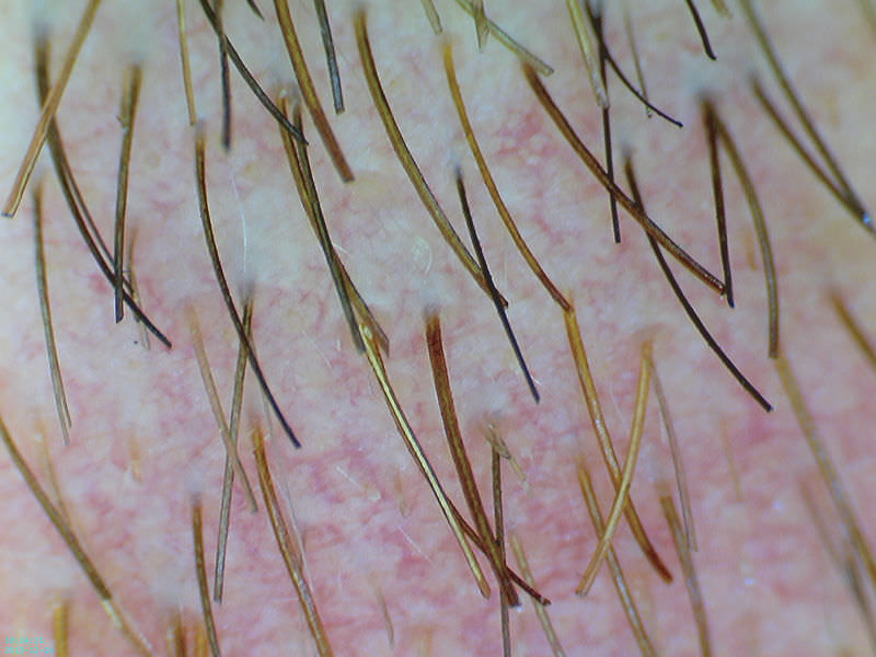 Dermatoscope vidéo - DE300 - Firefly Global - LED blanche / USB / pour PC