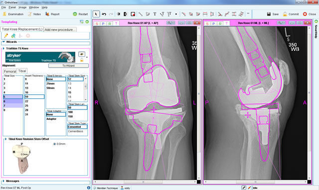 Logiciel de planification préopératoire - Knee Arthroplasty - OrthoView ...