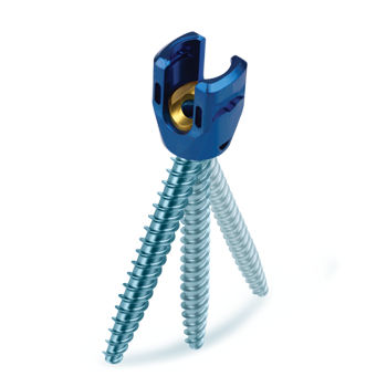 Vis pédiculaire de vertèbre lombo-sacrée - REVERE® Uniplanar - Globus ...