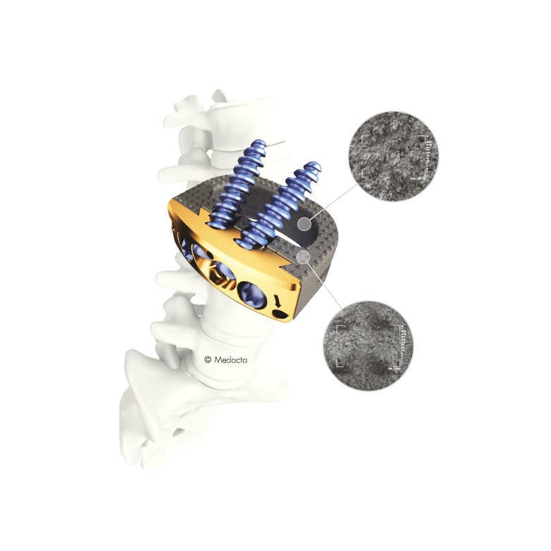Cage intersomatique lombaire - MectaLIF® - Medacta - voie antérieure ...