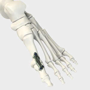 Vis d'arthrodèse d'articulation interphalangienne du pied - CrossTIE ...