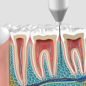 Seringue d'anesthésie dentaire - Soan - Dentalhitec - d'anesthésie ...