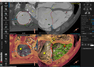 Logiciel TDM - 3mensio Mitral Valve - Pie Medical Imaging - pour ...