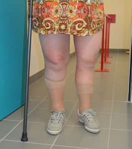 Prothèse partielle de main myo-électrique - Protunix - multi-articulée ...