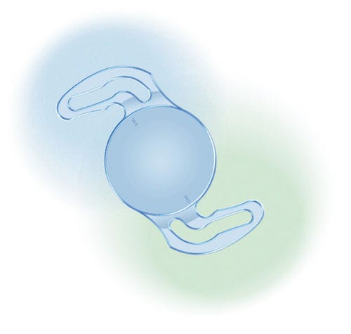 Lentille intraoculaire torique - EVToric - Aurolab - astigmatisme