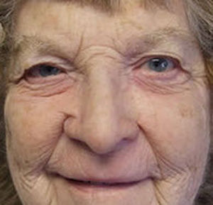 Épithèse nasale - Medical Art Prosthetics - adulte