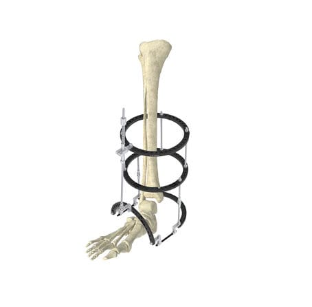 Fixateur externe de cheville - Wuxi Betta Medical Technology - circulaire