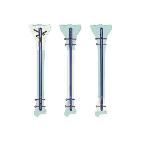Clou intramédullaire de tibia - KTO - Kangli Medical - fixation ...