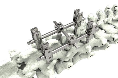 Vis pédiculaire de vertèbre thoraco-lombaire - M10-Ia - Waston medical ...