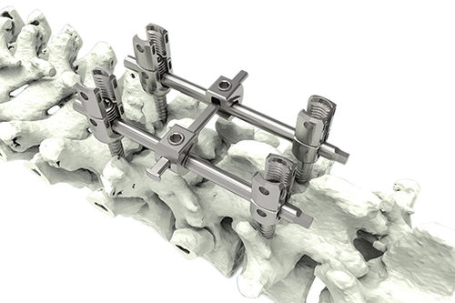 Vis pédiculaire thoraco-lombaire - M9-Ia - Waston medical - polyaxiale ...