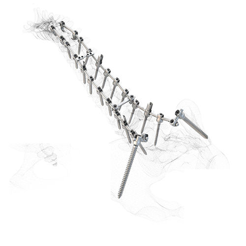 Vis pédiculaire polyaxiale - WSI MX/PX® - Peter Brehm - monoaxiale ...