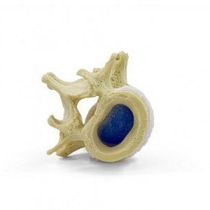 Modèle anatomique de vertèbres - A L4-L5 - Dynamic Disc Designs Corp ...