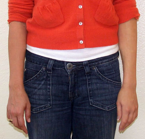 Épithèse d'avant-bras - Aesthetic Prosthetics - adulte