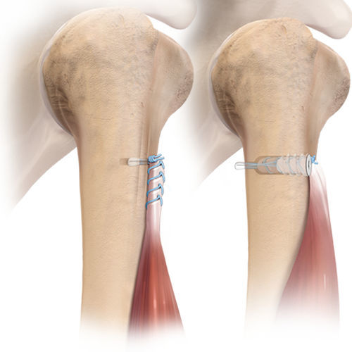 Ancre de suture de tendon bicipital - FiberTak® 2-0 FiberLink ...