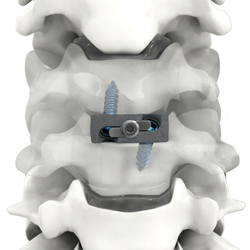 Cage intersomatique cervicale - PRO-LINK® - Life Spine - voie ...