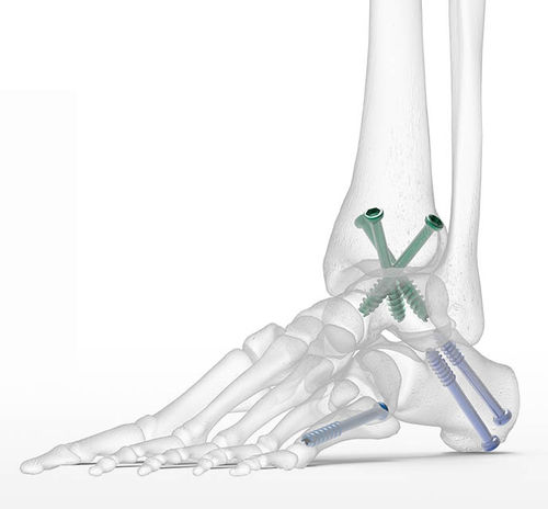 Vis de compression à os de pied - Acumed - canulée / métallique